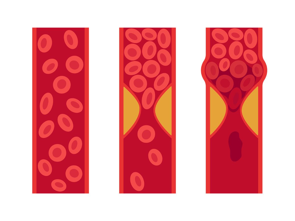 Az érszűkület 10 jele, ami szívrohamhoz vezethet - Nők Lapja