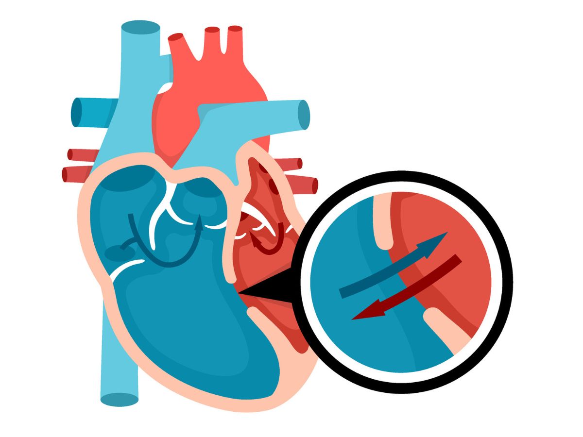 Lyukas szív: a rejtett veszély, amit sokan észre sem vesznek